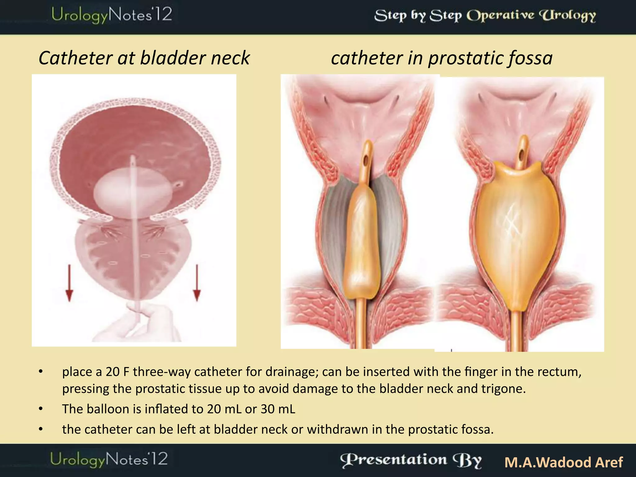 TURP step by step operative urology | PDF