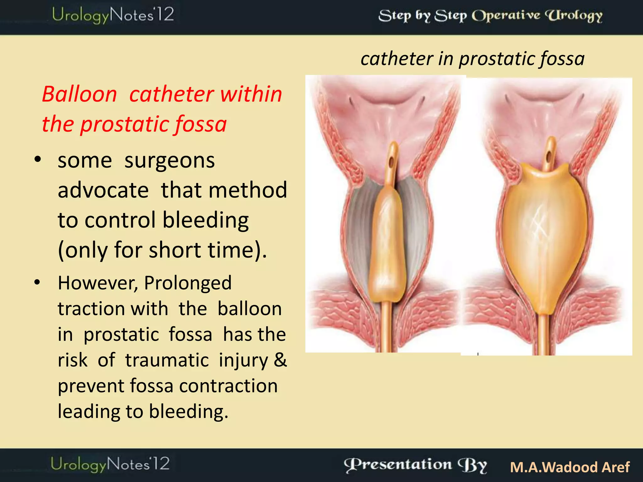 TURP step by step operative urology | PDF