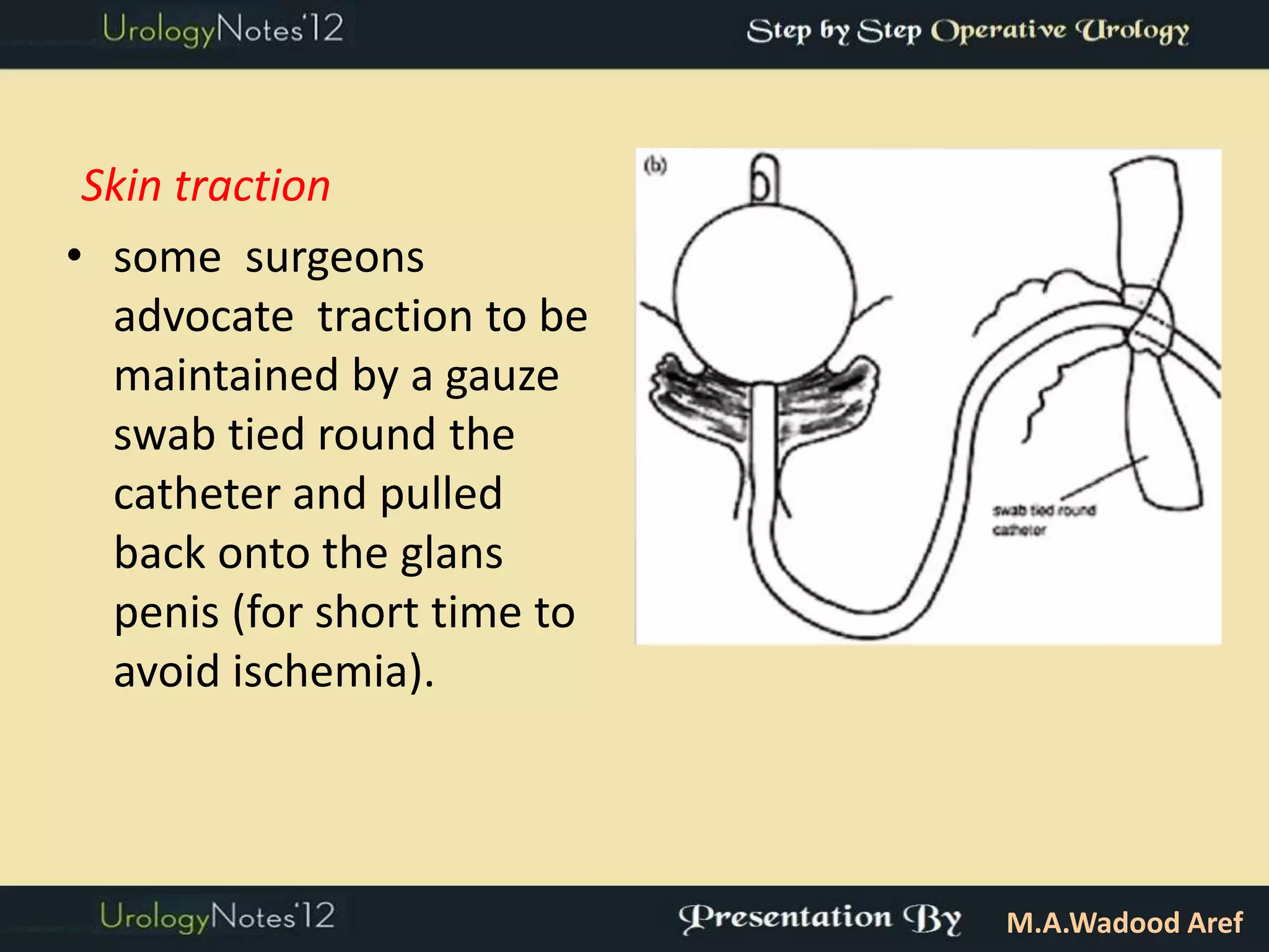 TURP step by step operative urology | PDF