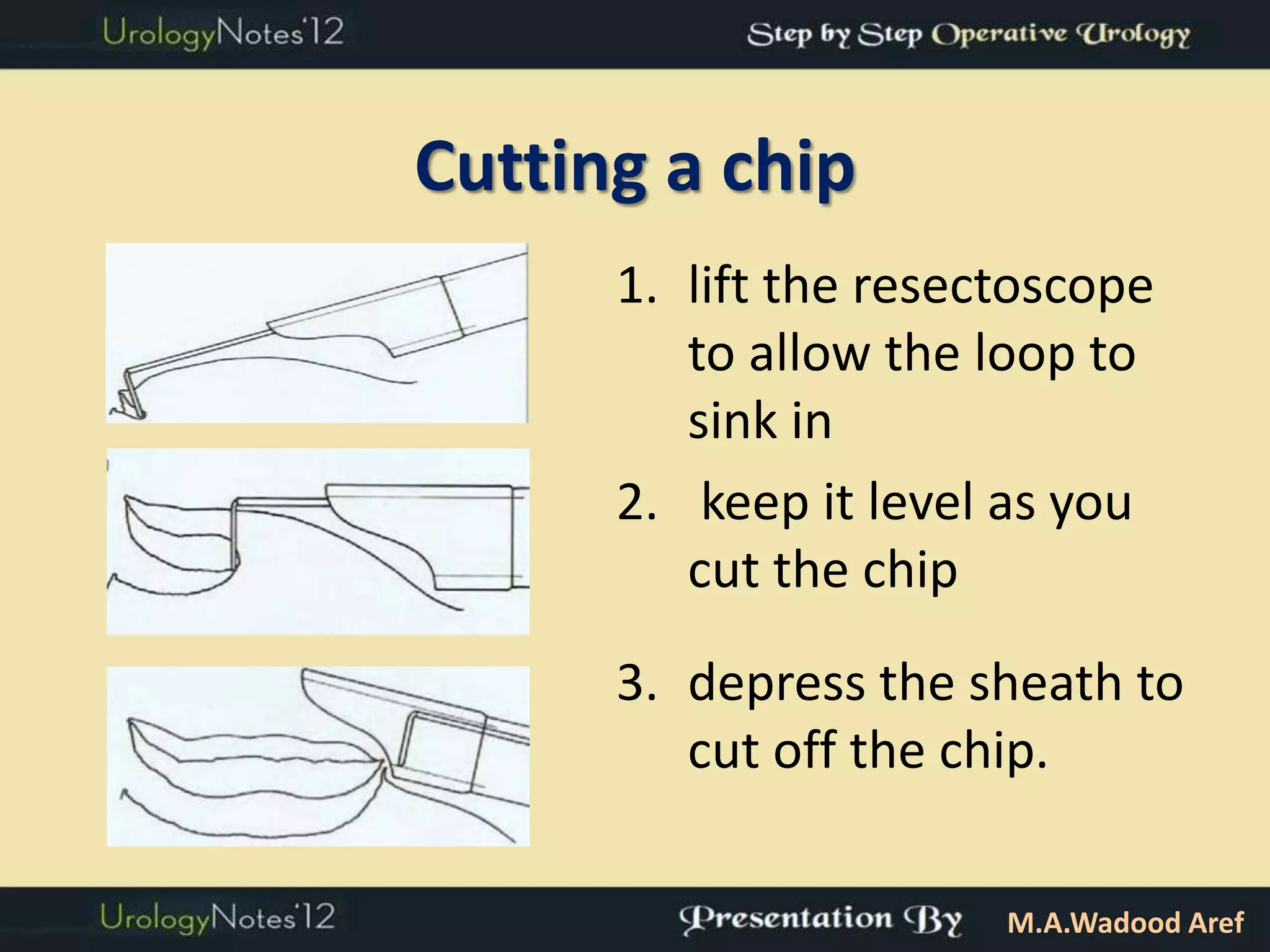 TURP step by step operative urology | PDF