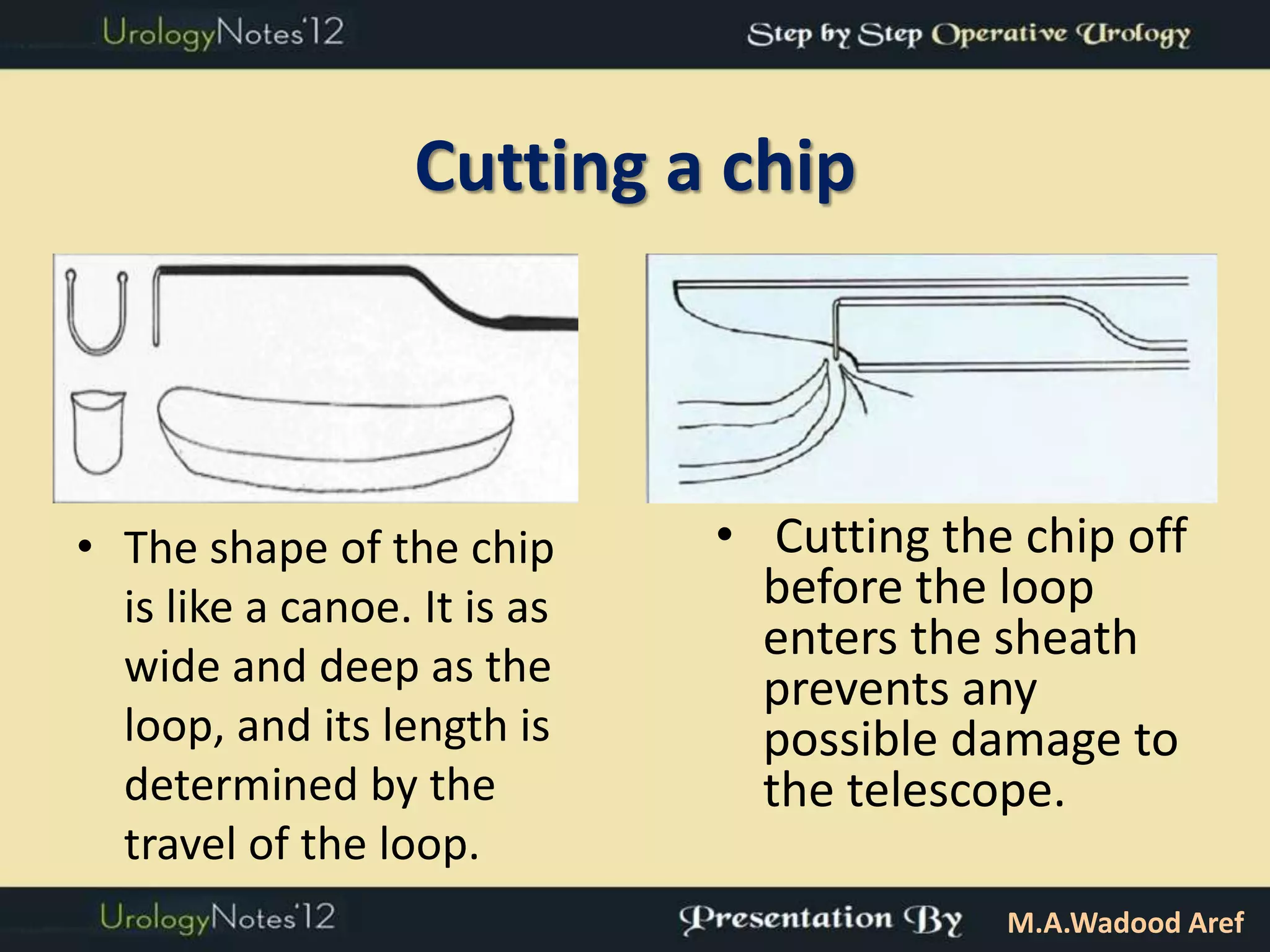 TURP step by step operative urology | PDF