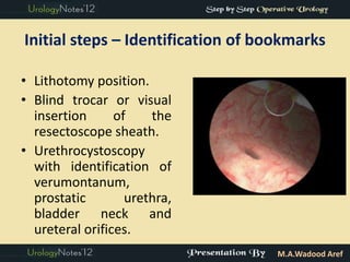 TURP step by step operative urology | PDF