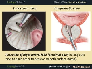 TURP step by step operative urology | PDF