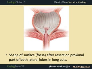 TURP step by step operative urology | PDF