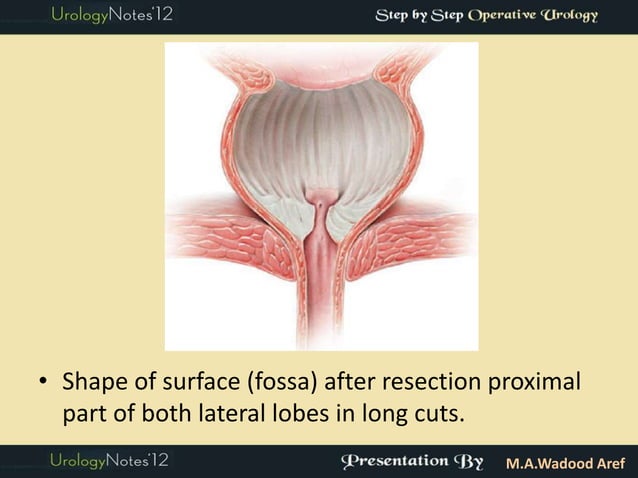 TURP step by step operative urology | PDF | First Aid | Injuries