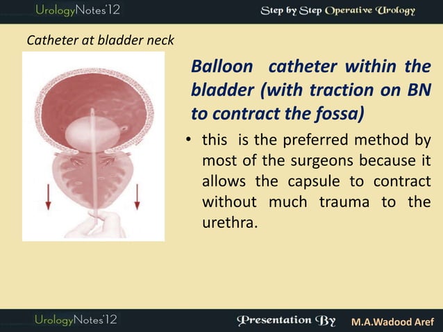 TURP step by step operative urology | PDF | First Aid | Injuries