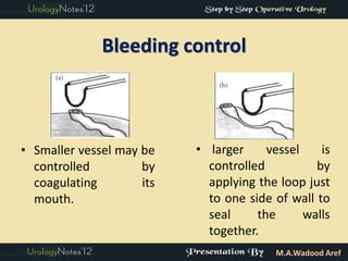 TURP step by step operative urology | PDF