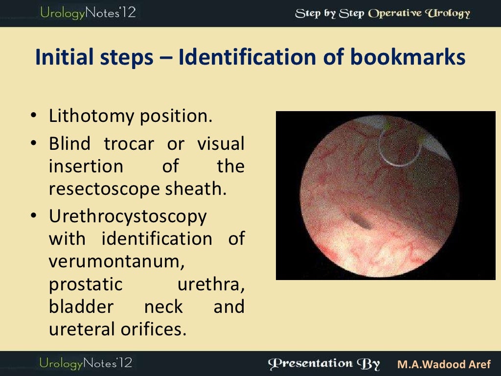 TURP step by step operative urology