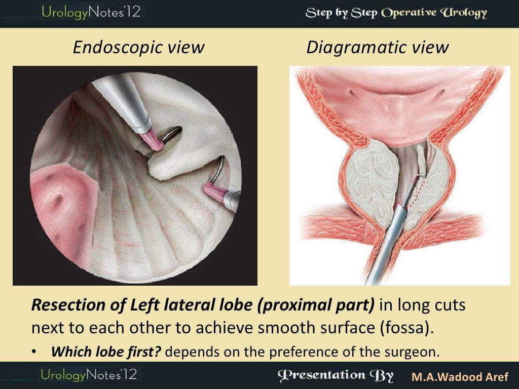 TURP Step By Step Operative Urology TURP Step By Step Operative Urology