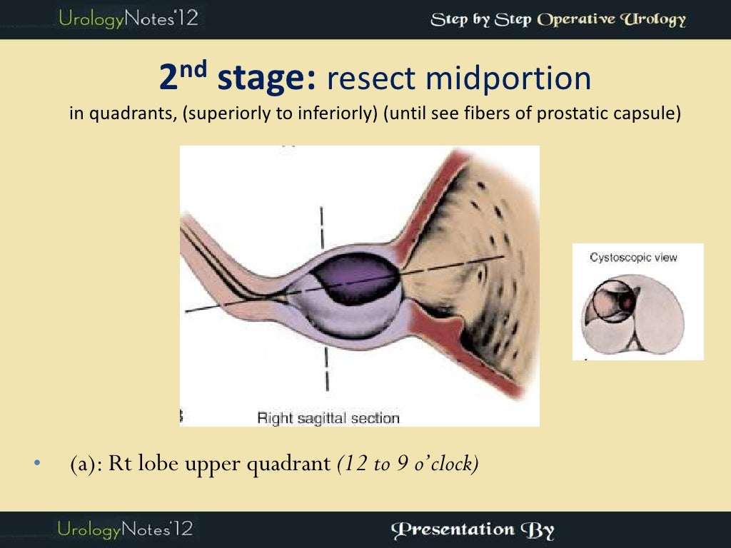 TURP Step By Step Operative Urology turp-step-by-step-operative-urology