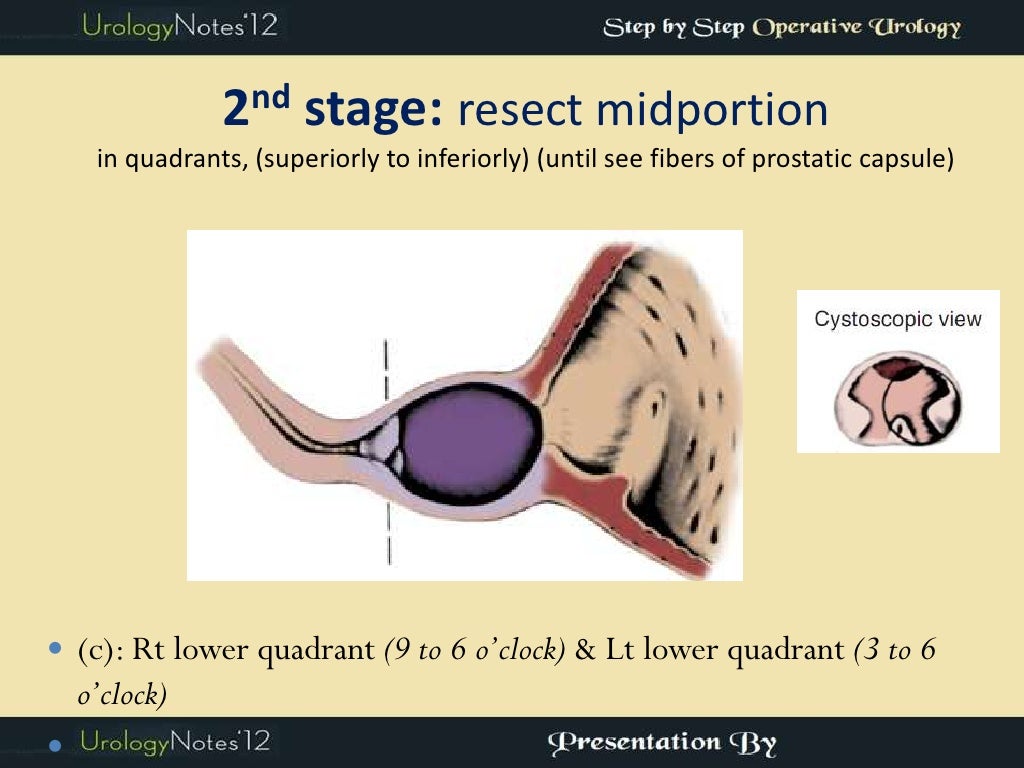 TURP step by step operative urology