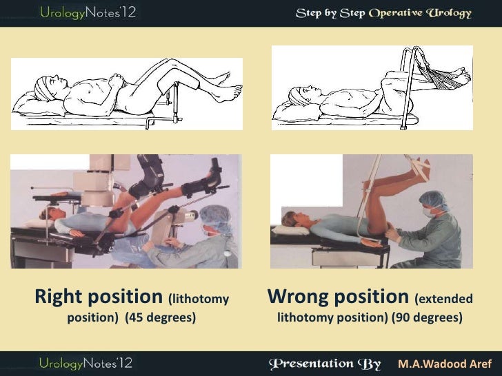 TURP step by step operative urology