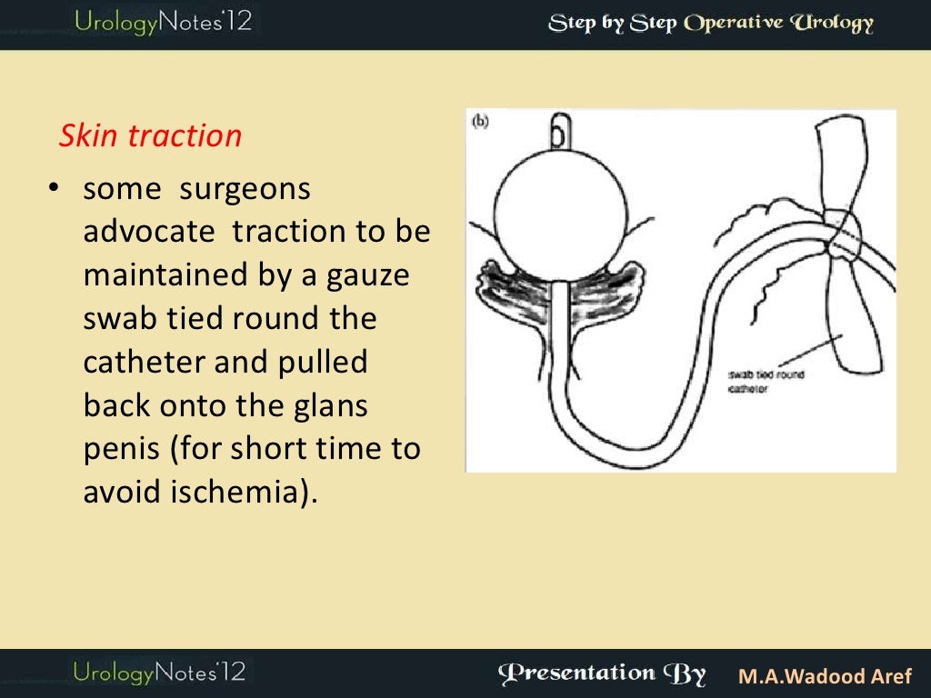 TURP Step By Step Operative Urology turp-step-by-step-operative-urology