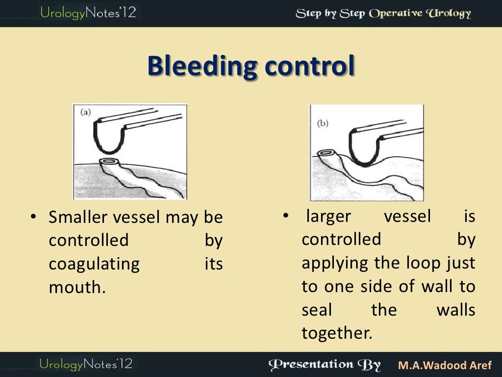 TURP step by step operative urology