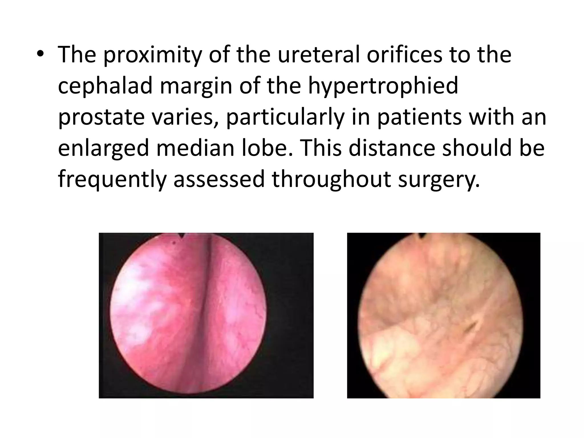 Turp techniques | PPTX