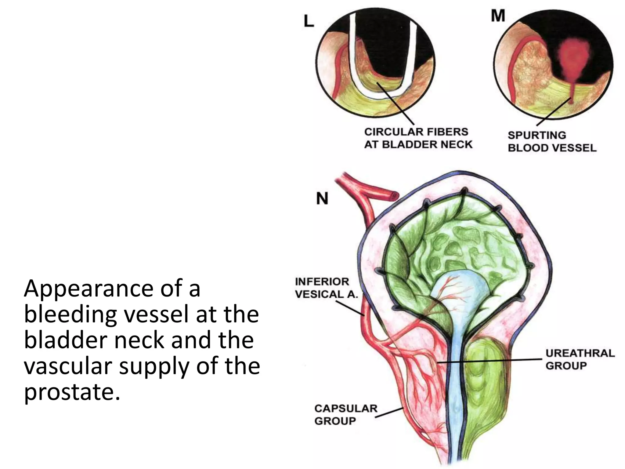 Turp techniques | PPTX