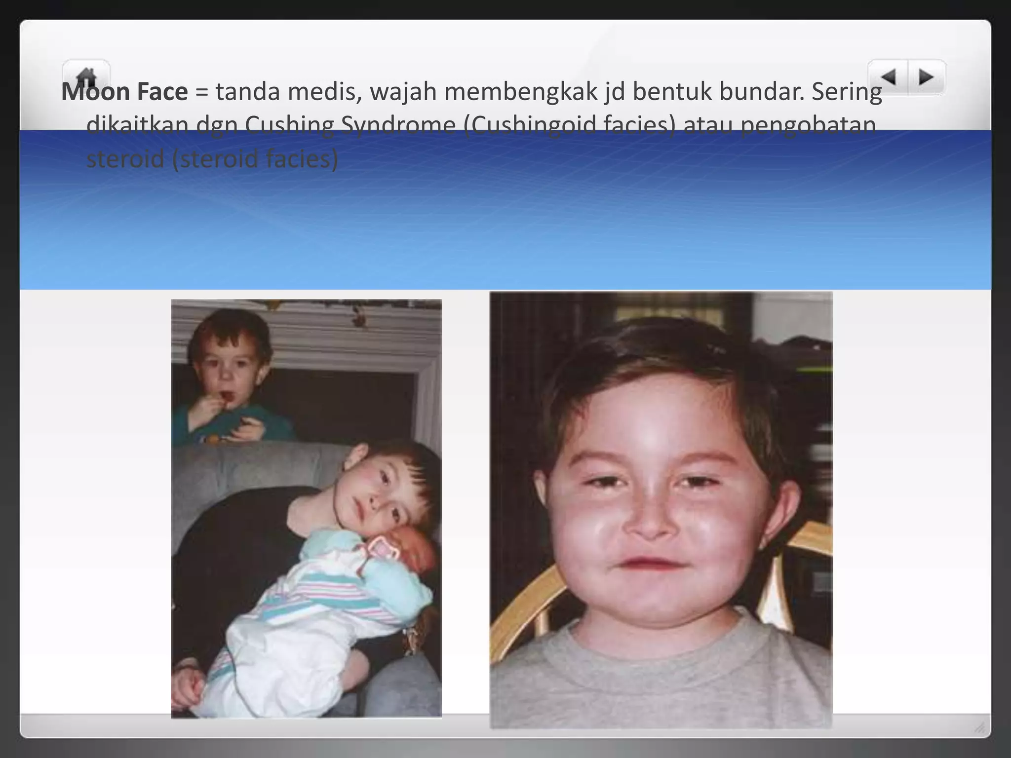 Cushing Syndrome | PPTX