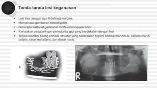 pembahsan kasus tumor metastasis pada rahang | PPTX