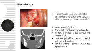 pembahsan kasus tumor metastasis pada rahang | PPTX