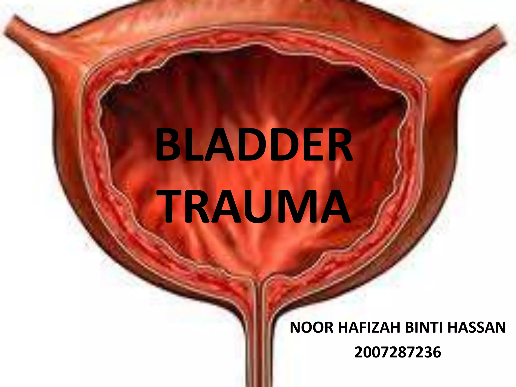 Tutorial bladder trauma | PPTX