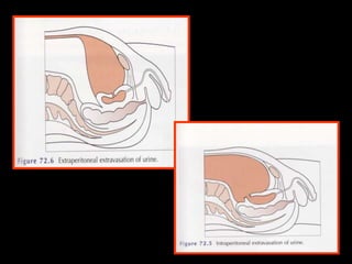 Tutorial bladder trauma | PPTX