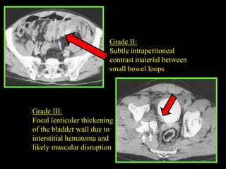 Tutorial bladder trauma | PPTX