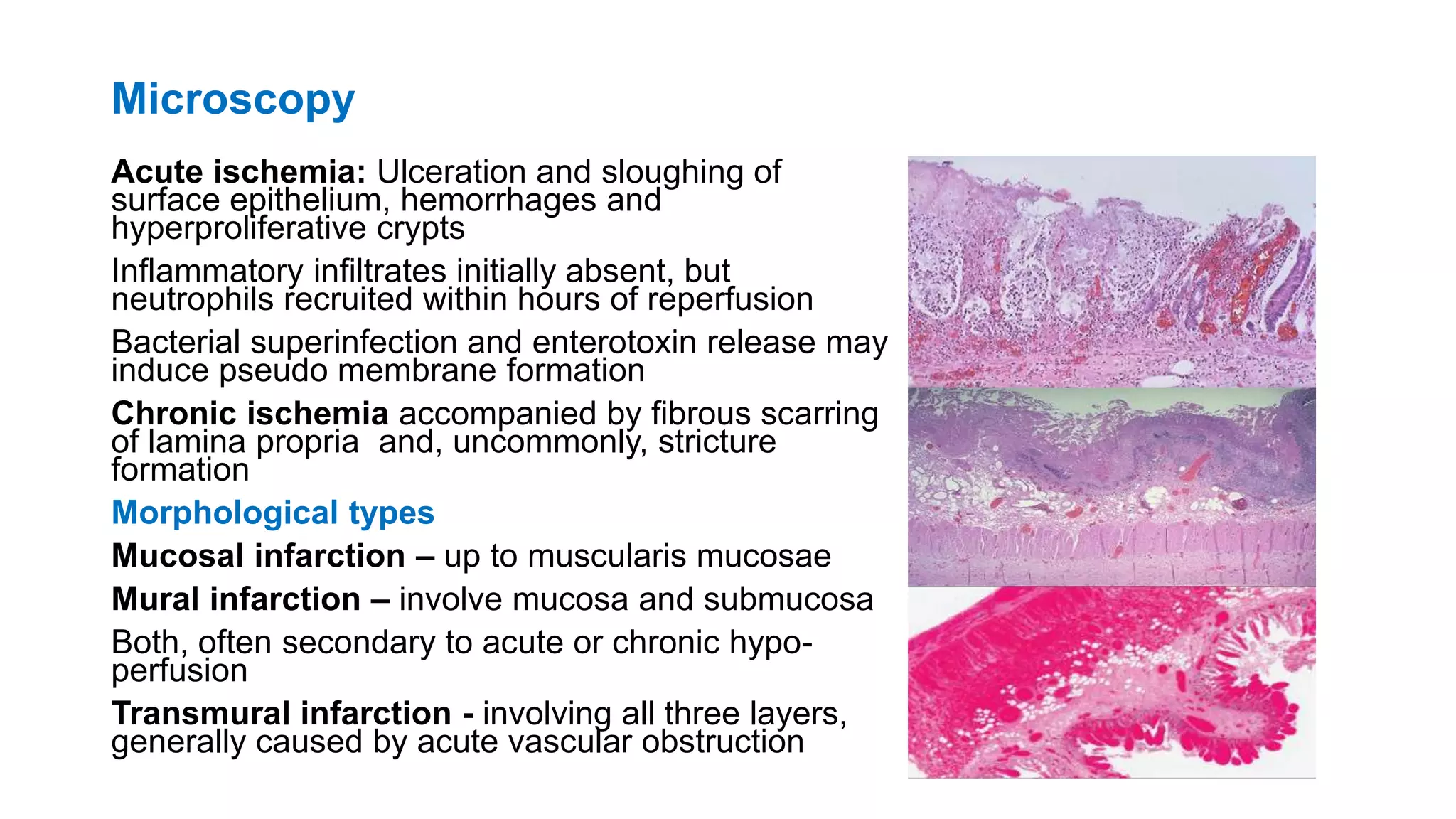 Ischemic bowel disease | PPTX