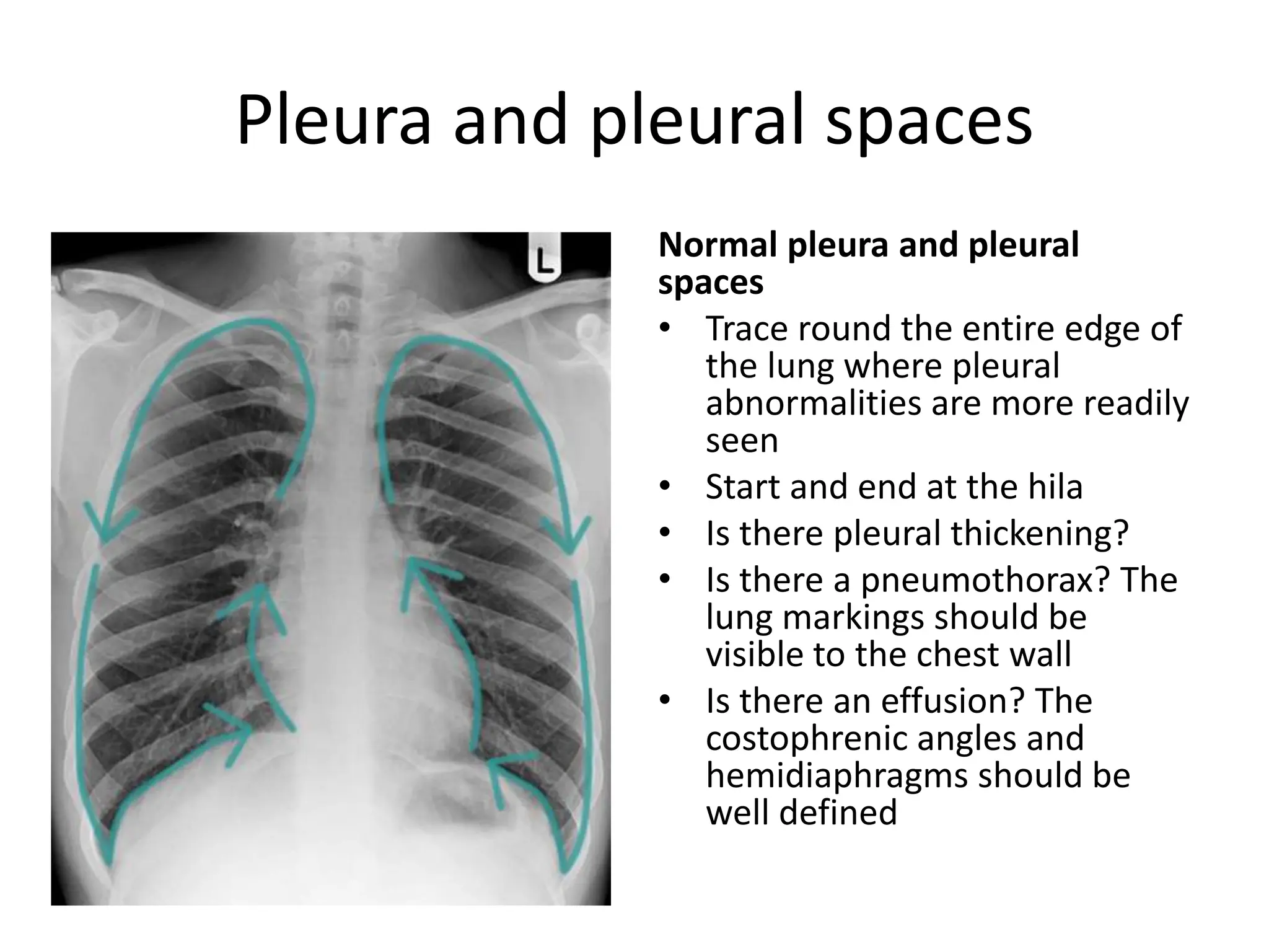 Chest X-Ray Anatomy. | PPTX