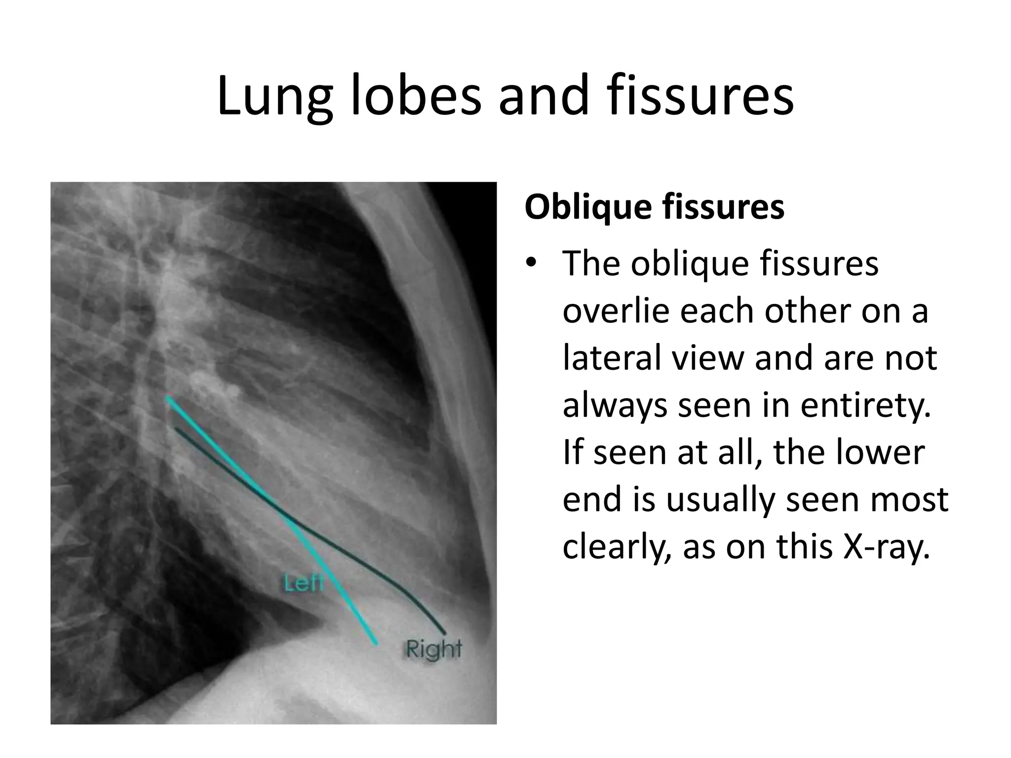 Chest X-Ray Anatomy. | PPTX