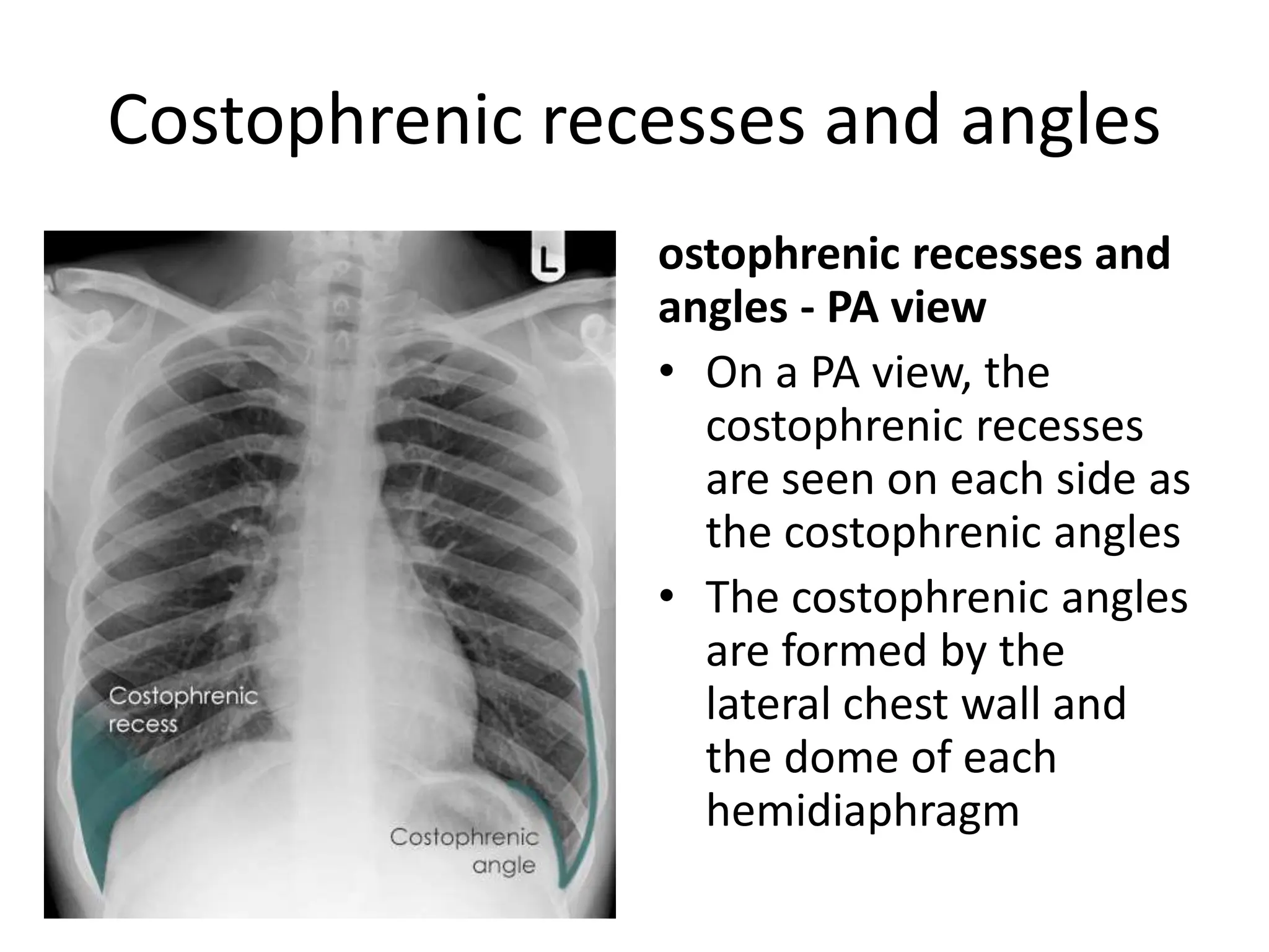Chest X-Ray Anatomy. | PPTX