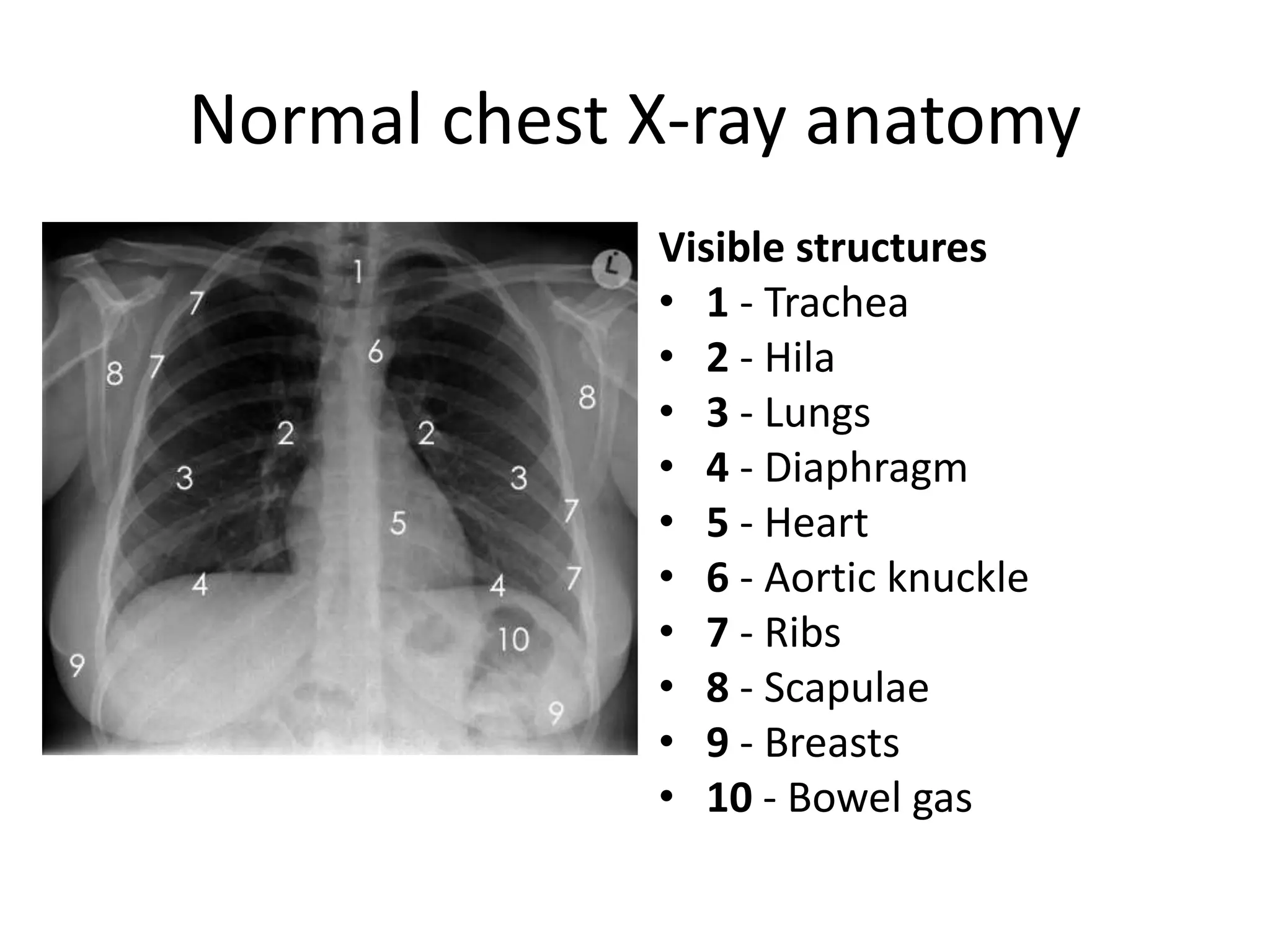 Chest X-Ray Anatomy. | PPTX