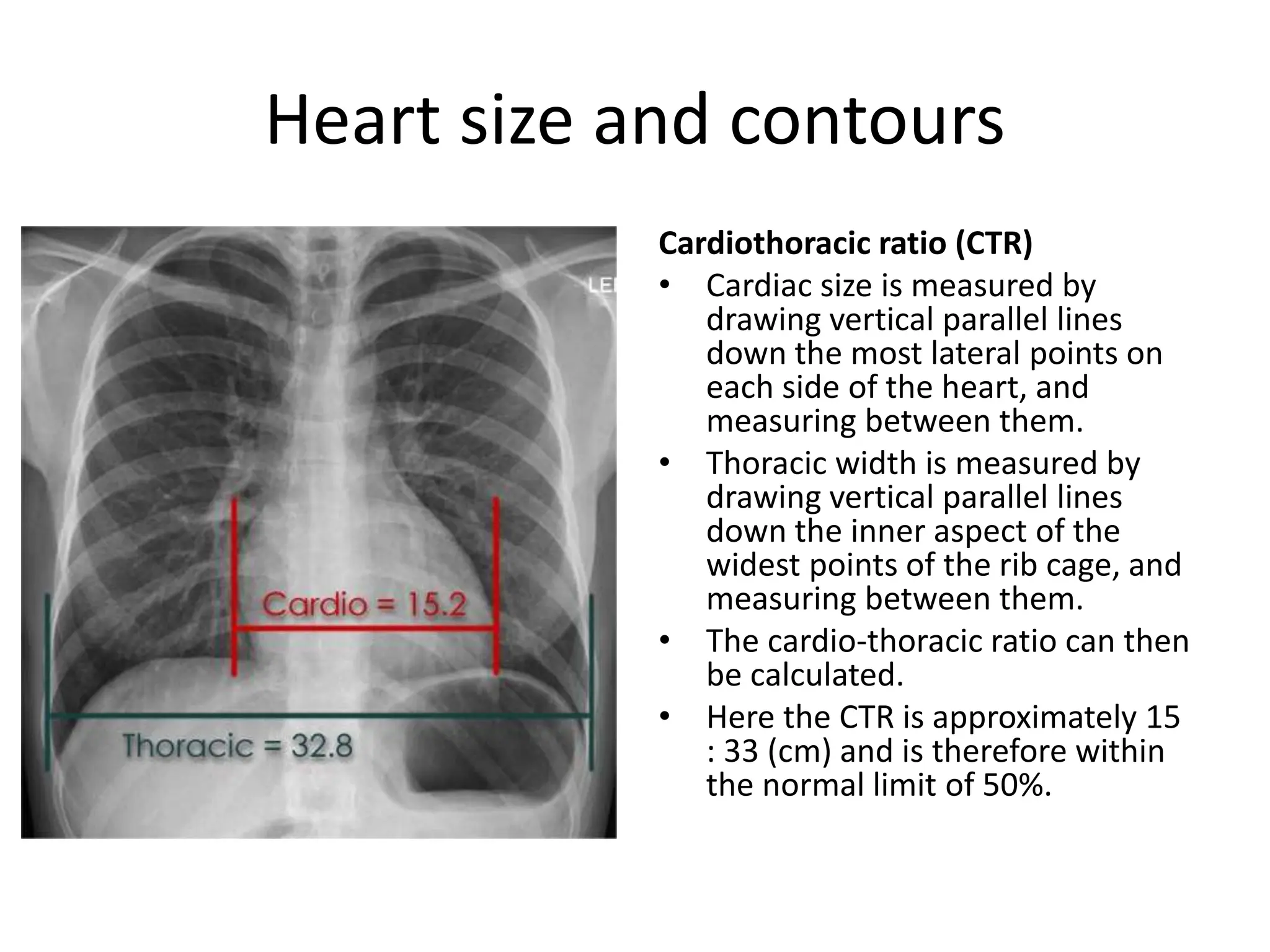 Chest X-Ray Anatomy. | PPTX