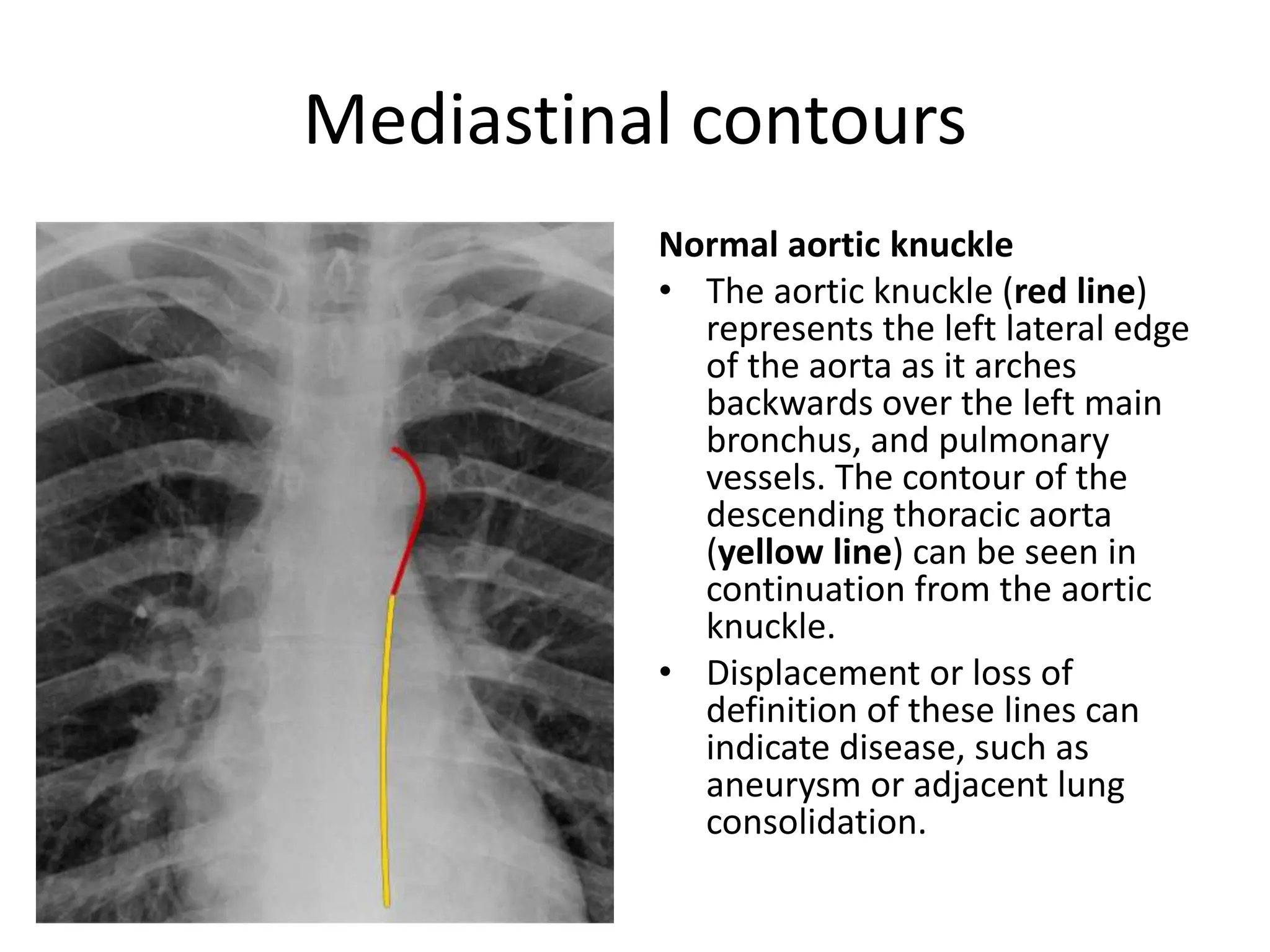 Chest X-Ray Anatomy. | PPTX