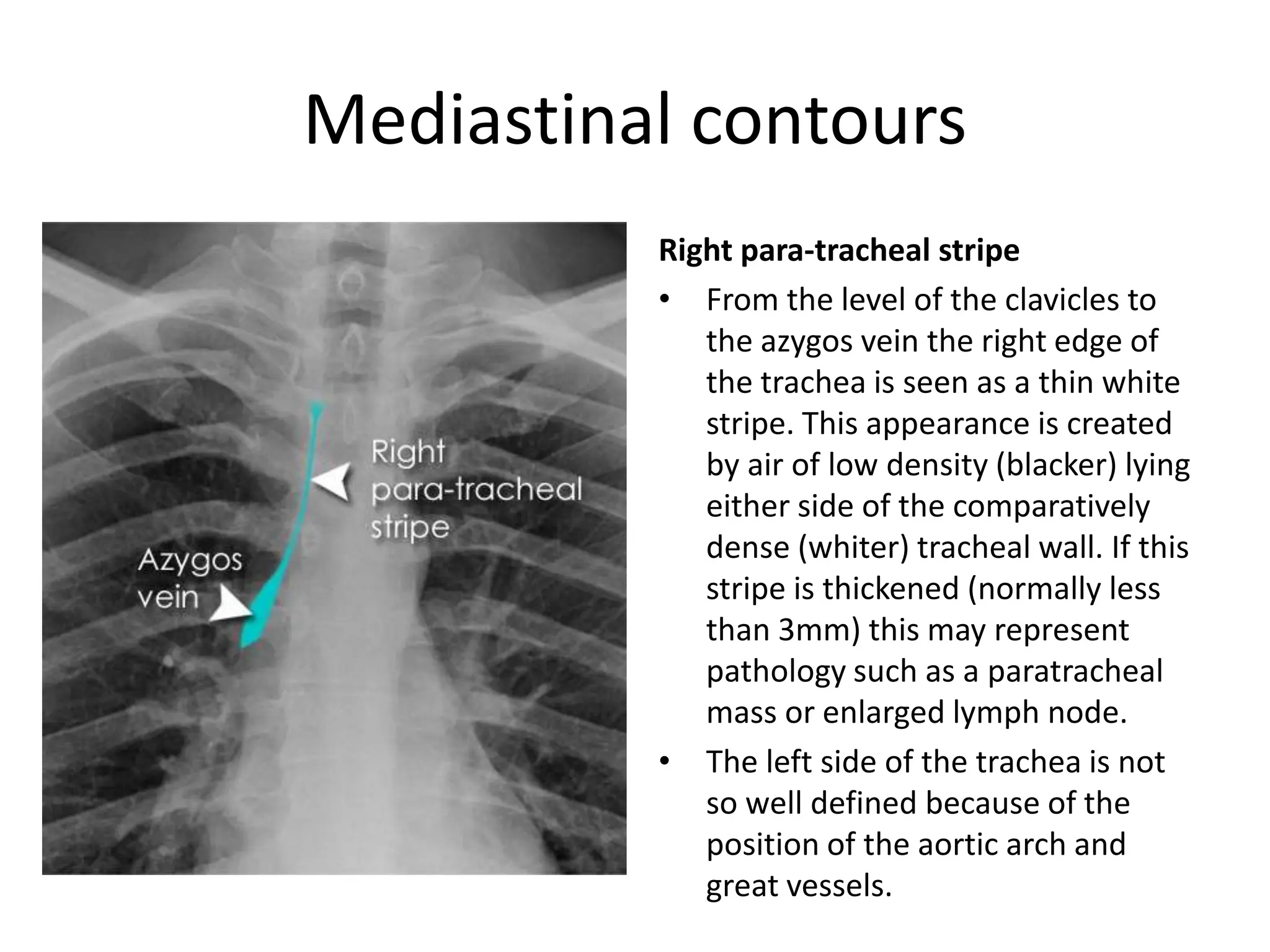 Chest X-Ray Anatomy. | PPTX