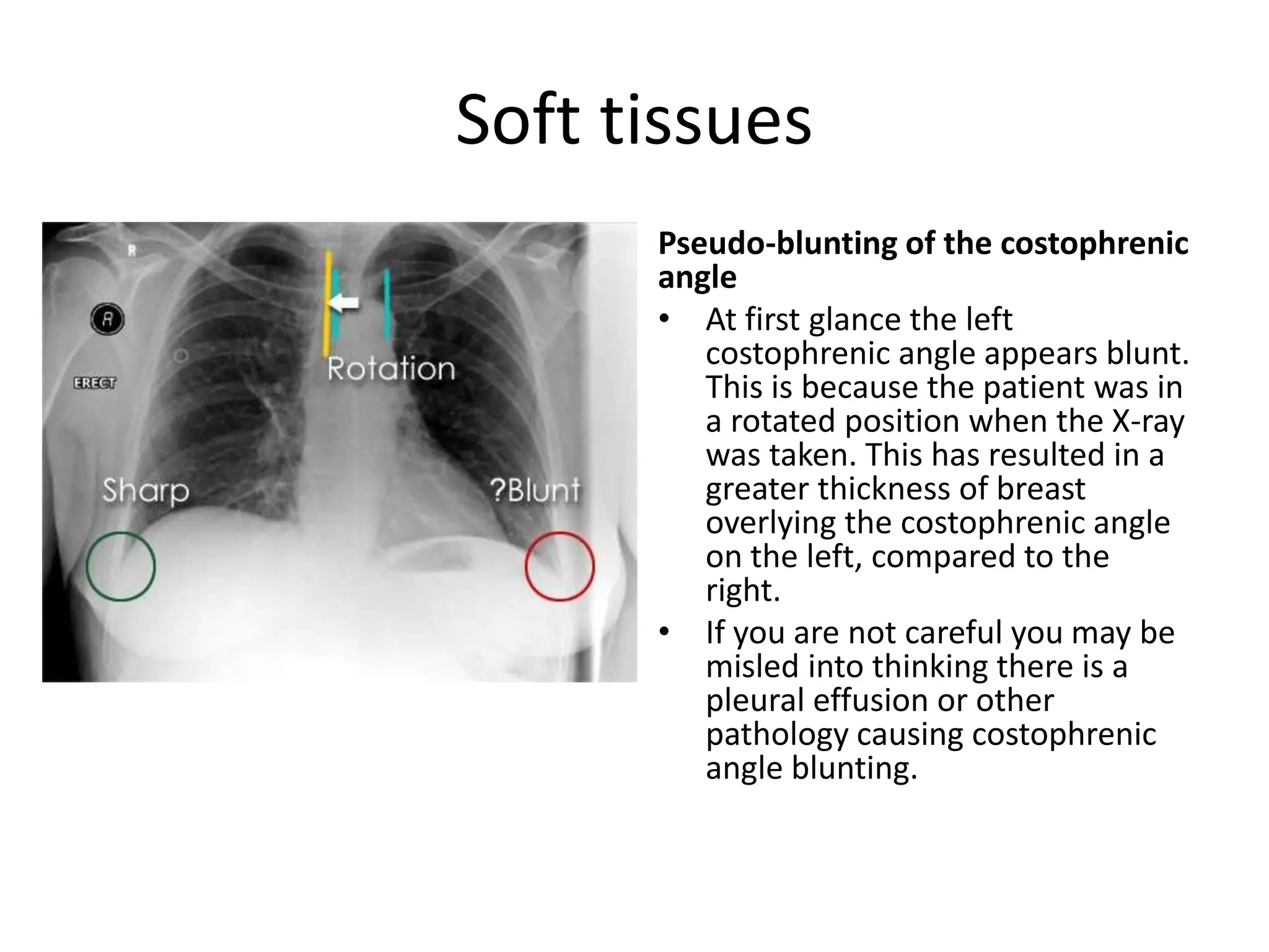 Chest X-Ray Anatomy. | PPTX