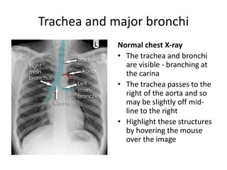 Chest X-Ray Anatomy. | PPTX