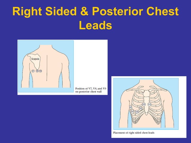 Tutorial in ecg | PPT