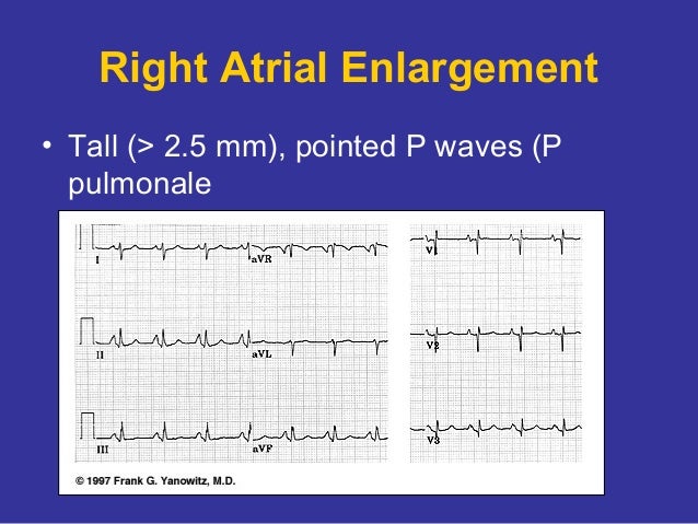 Tutorial in ecg