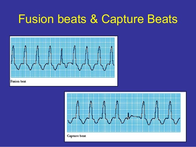 Tutorial in ecg