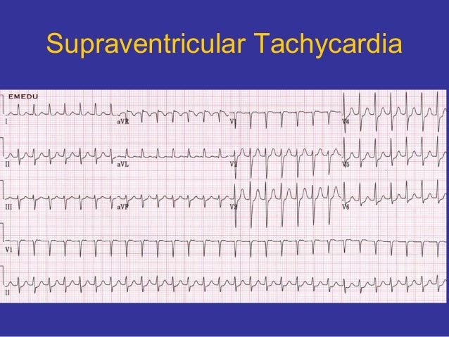 Tutorial in ecg