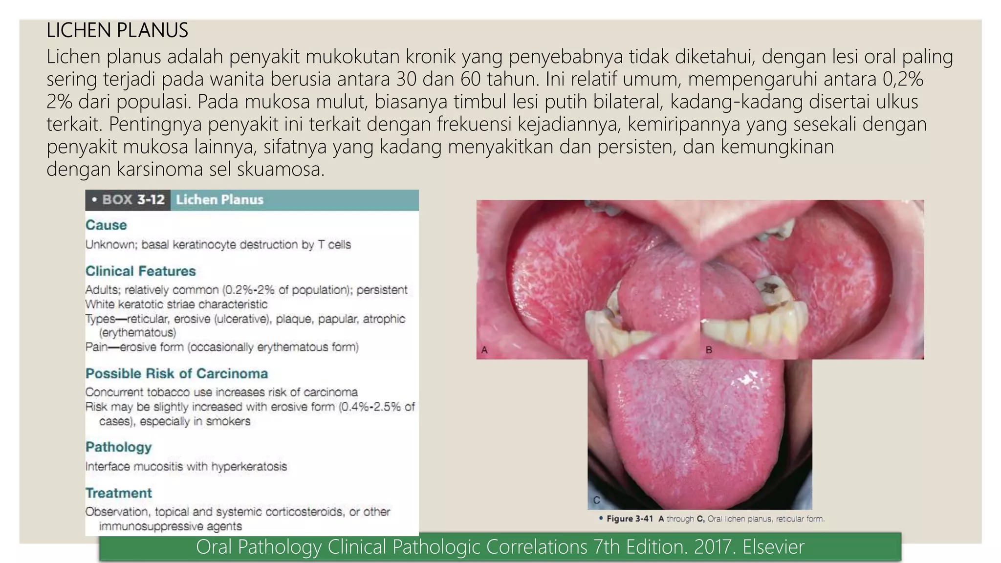 Lesi Putih, Variasi Normal, Leukoplakia | PPTX
