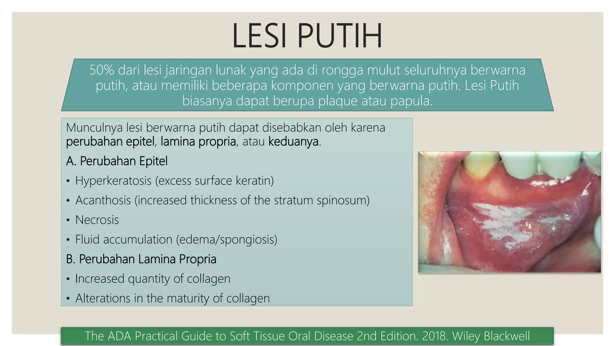Lesi Putih, Variasi Normal, Leukoplakia | PPTX