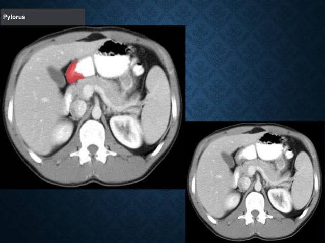 Tutorial Abdominal CT scan test.pdf | Endocrine and Metabolic Diseases ...