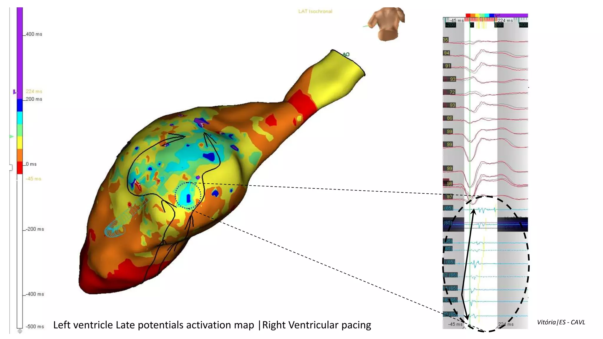 VT mapping | ischemic cardiomyopathy | PPTX