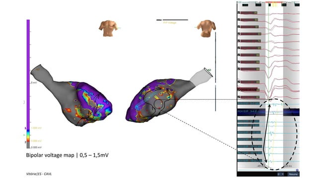 VT mapping | ischemic cardiomyopathy | PPTX