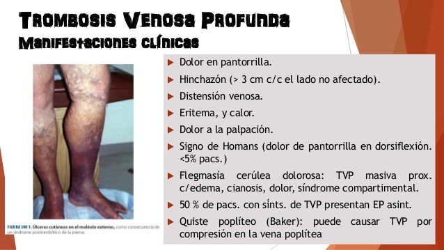 Trombosis Venosa Profunda en el Paciente Quirúrgico