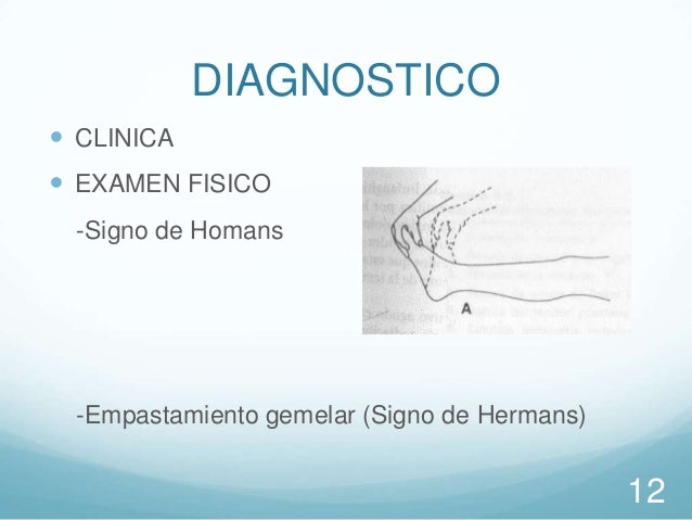 Trombosis venosa profunda - revision de evidencia (CHEST)