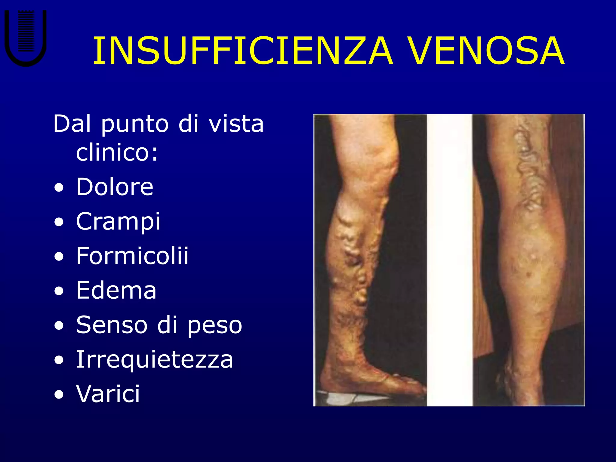 TROMBOSI VENOSA PROFONDA TVP LEZIONE MEDICINA INTERNA ROBERTO LEO 2019 ...