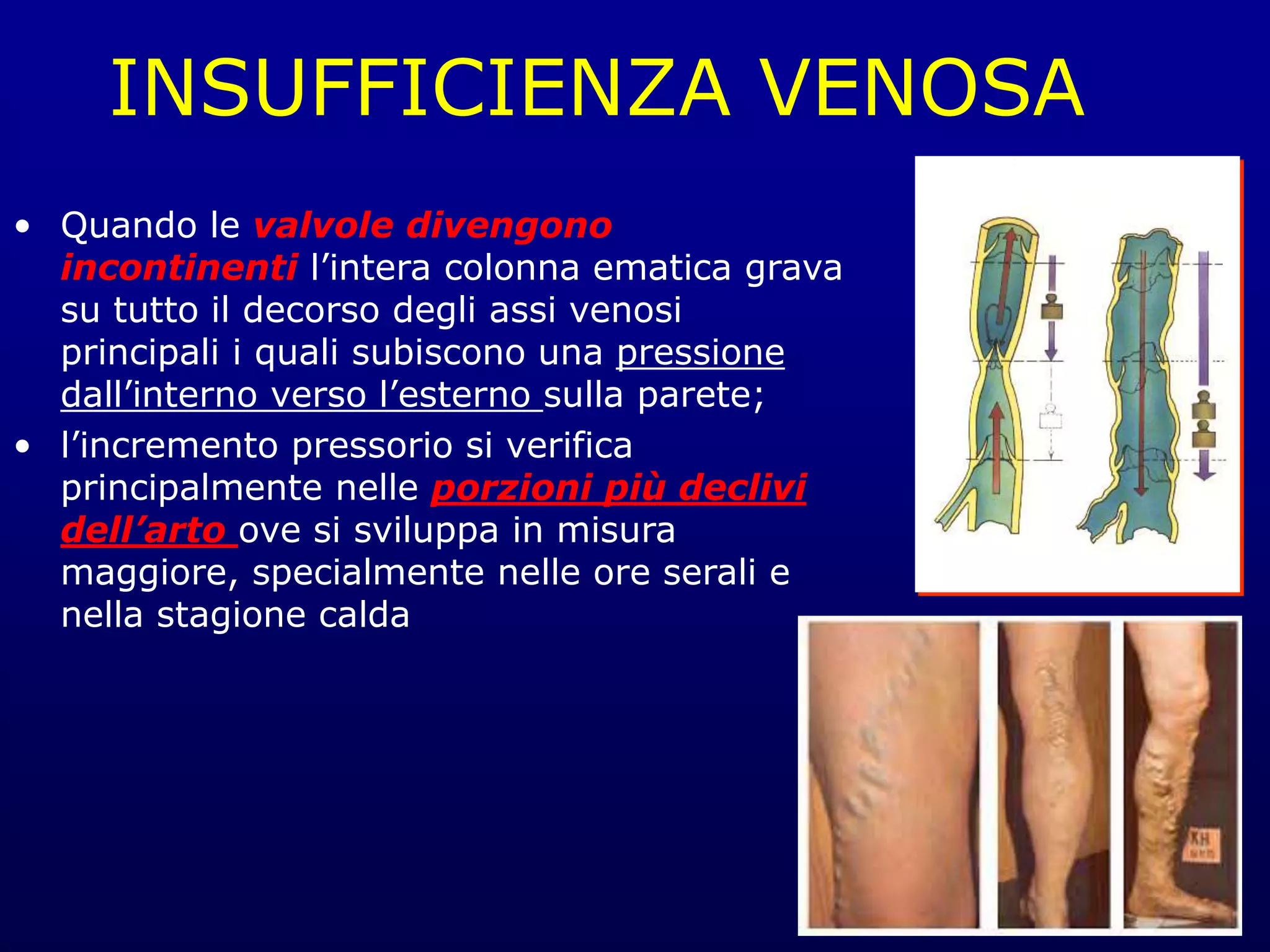TROMBOSI VENOSA PROFONDA TVP LEZIONE MEDICINA INTERNA ROBERTO LEO 2019 ...