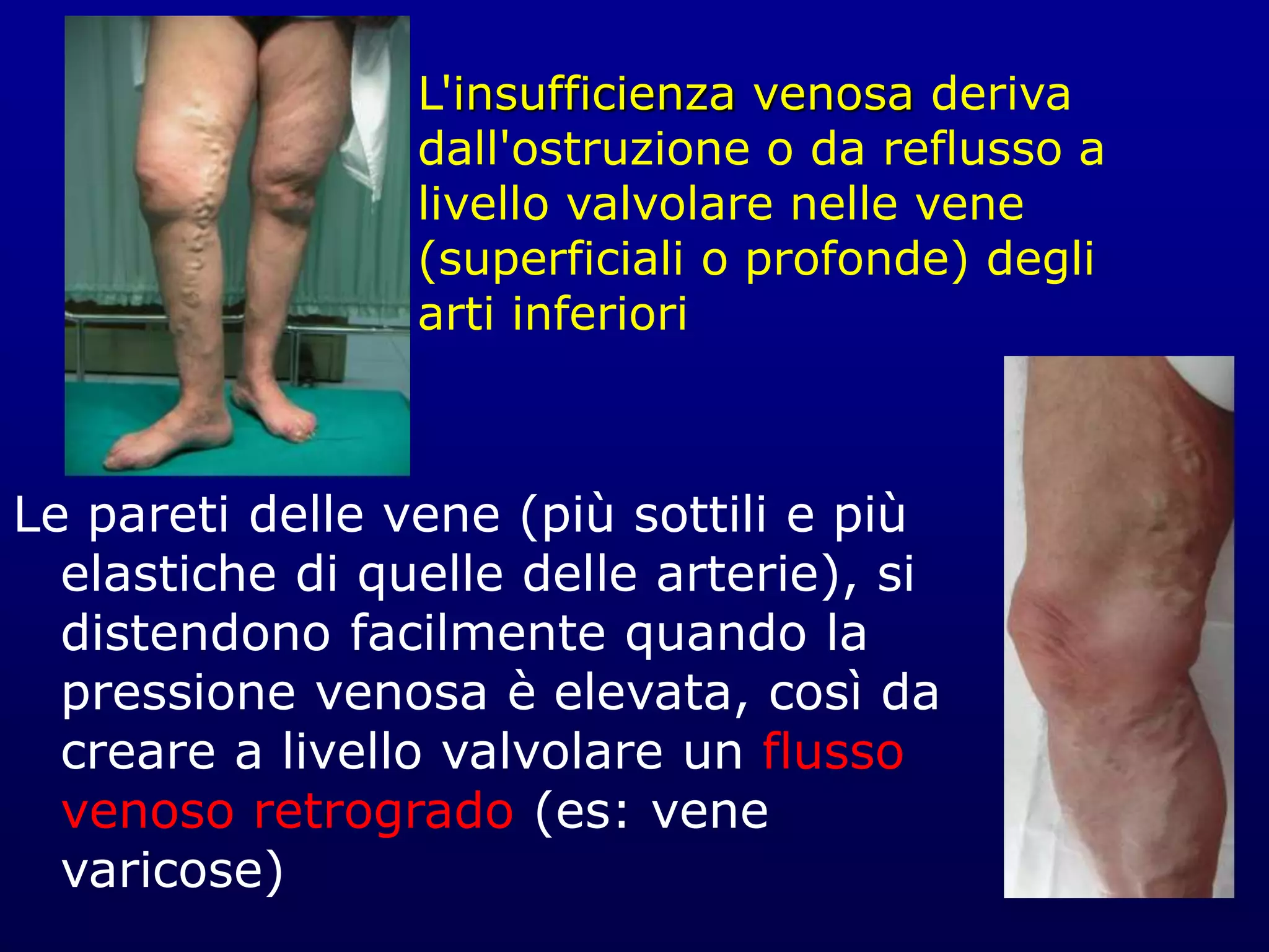 TROMBOSI VENOSA PROFONDA TVP LEZIONE MEDICINA INTERNA ROBERTO LEO 2019 ...